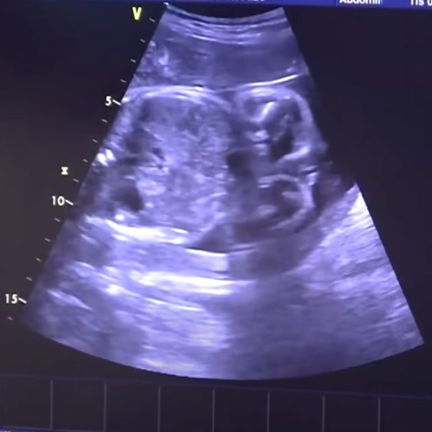 Miracle baby born 117 days after mother is declared brain-dead