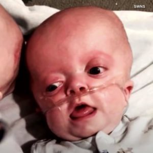 Twins with rare disorder rejected by parents so nurse goes above and beyond